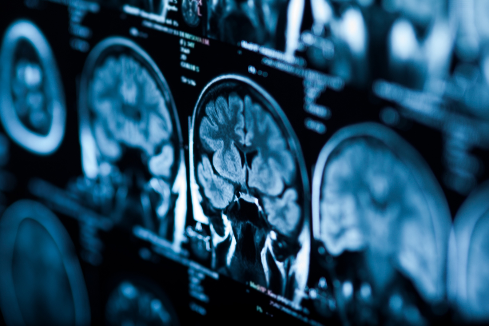 Long COVID's impact on the brain shown by world's strongest MRI